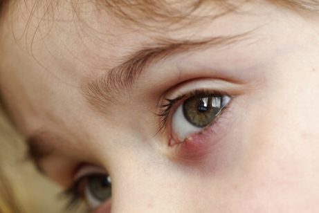 Styes in Children: How to Treat Them - You are Mom