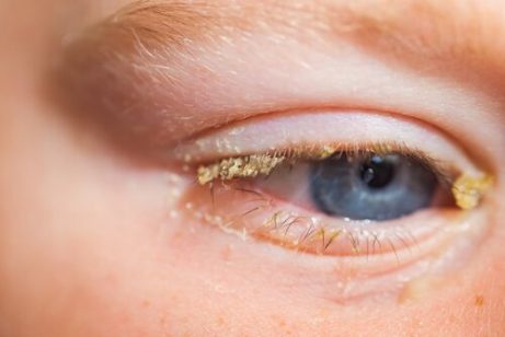 Conjunctivitis in Babies: Causes, Symptoms and Treatment - You are Mom