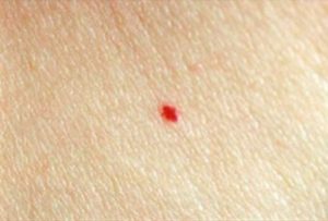 Types of Moles and How to Identify Them - You are Mom