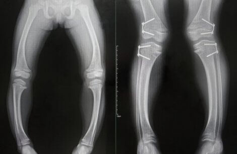 Rickets: Vitamin D Deficiency in Children - You are Mom