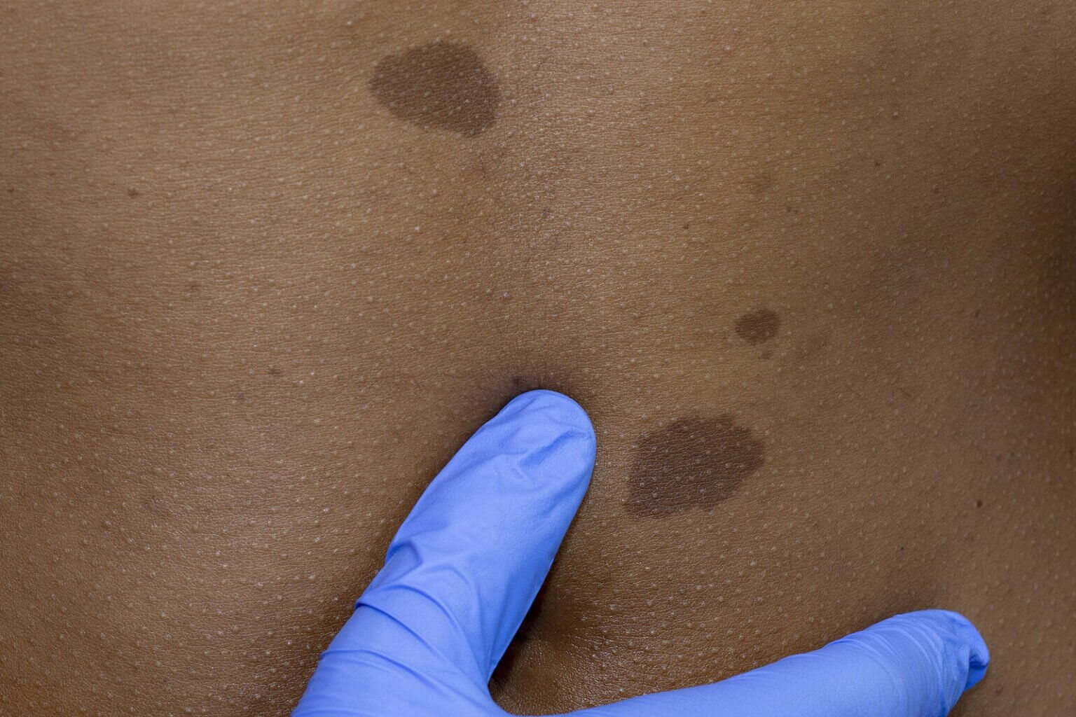 Caf au Lait Spots In Children You Are Mom caf-au-lait-spots-in-children-you-are-mom