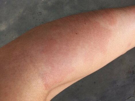 Systemic Lupus Erythematosus in Children - You are Mom