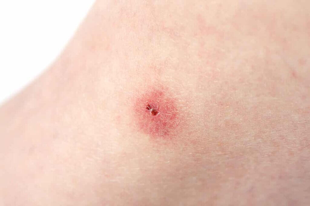 All About Flea and Spider Bites in Children - You are Mom