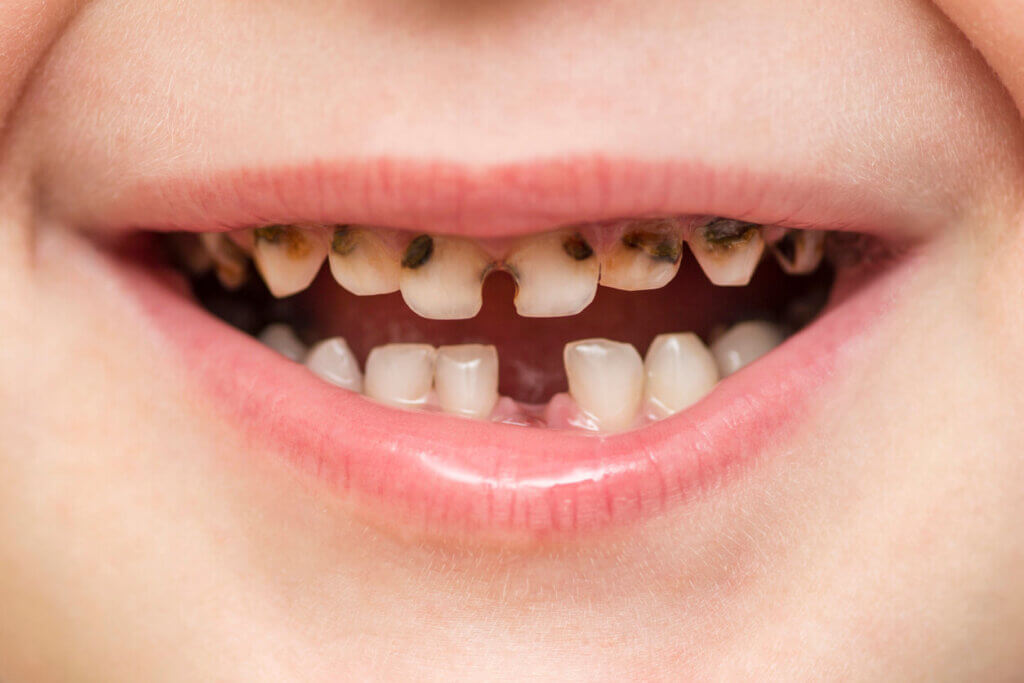 My Child's Tooth Has Turned Gray: Why?