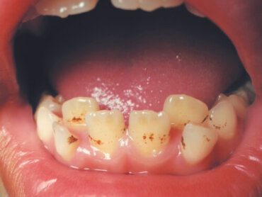 Stains on Children's Teeth Due to Iron Supplementation